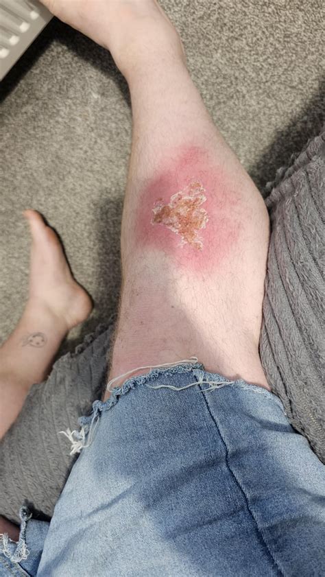 Astroturf Burn Turning Into Cellulitis Rdissectingcellulitis