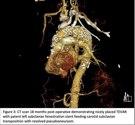 Carotid Subclavian Transposition