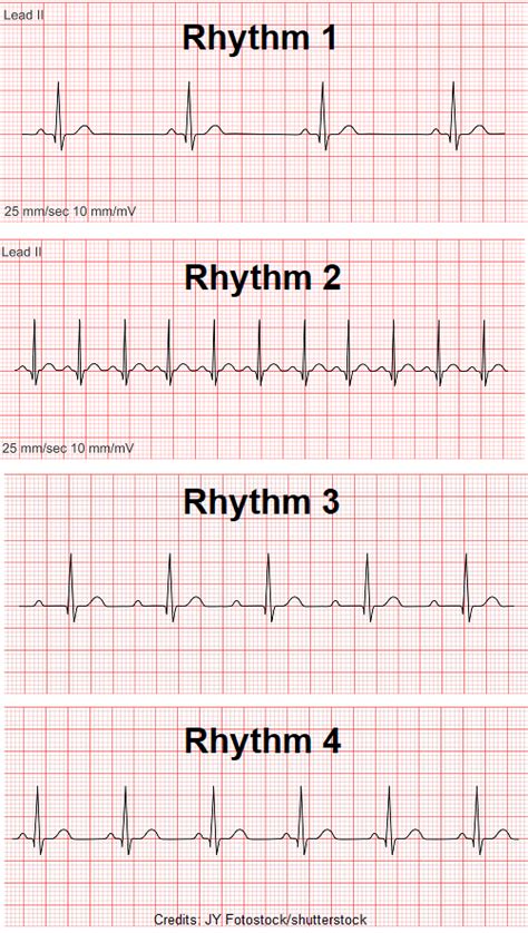 Normal Sinus Rhythm Ecg Ekg Interpretation Quiz