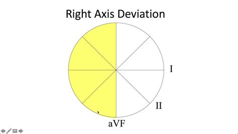 Determine Axis Deviation In 30 Seconds Youtube
