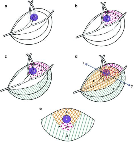 4 Schematic Diagram Showing Zones Of Prostate Gland In Superolateral 4 Schematic Diagram Showing Zones Of Prostate Gland In Superolateral