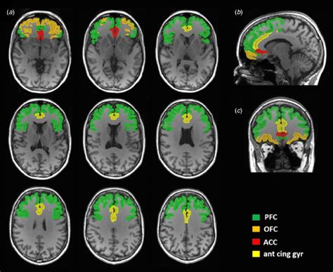 Masks For The Frontal Cortex The Mask Is Overlaid On A Structural Mri Download Scientific