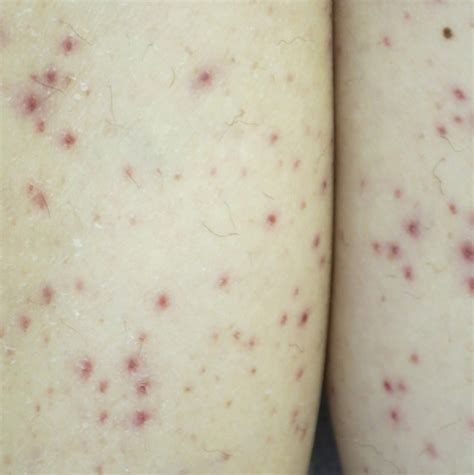 Follicular Hyperkeratosis Vitamin A Deficiency