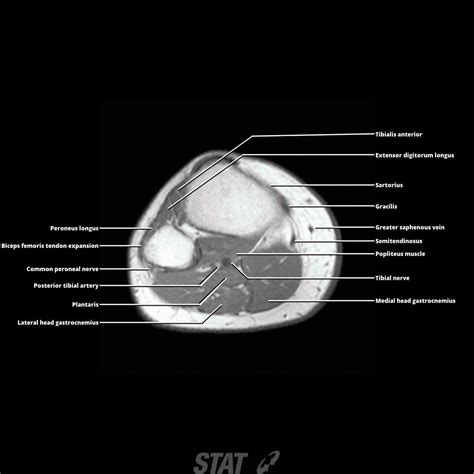 Mri Leg