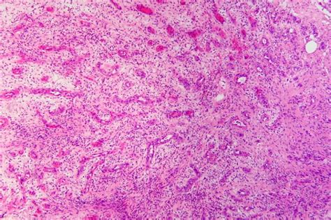 Difference Between Epithelialization And Granulation Compare The Difference Between Similar Terms