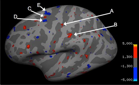 After A 2 Week Intervention Aimed To Rehabilitate Sensorimotor Skills