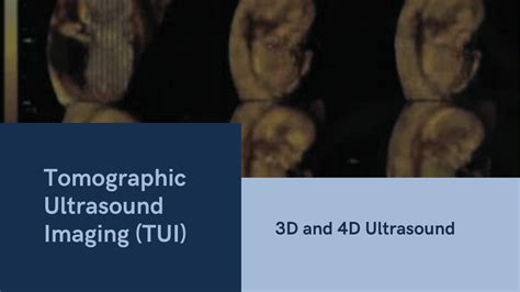 Tomographic Ultrasound Imaging Tui