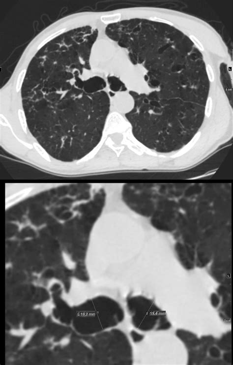 Faces Of Bronchiectasis The Common Vein