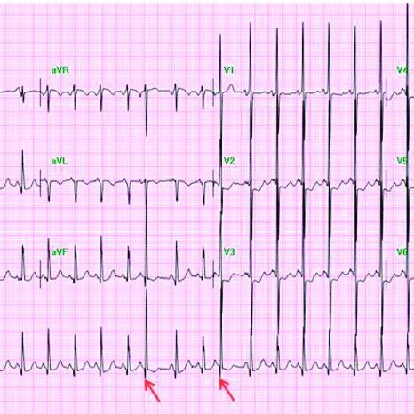 Atrial Flutter A Atrial Flutter With Atrioventricular Conduction Download Scientific