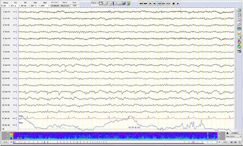 Interictal Scalp Eeg Showing Frequent Isolated Spikes And Sharp Waves