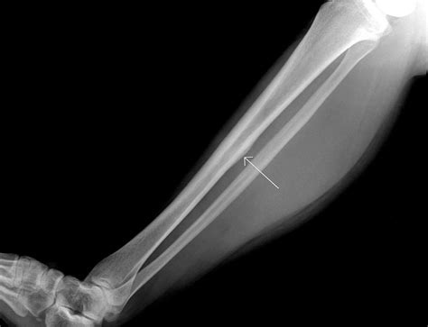 Síntomas De Fractura De Tibia