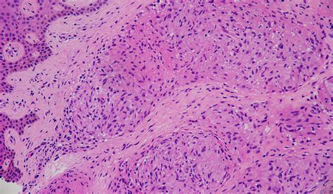 Sarcoidosis What Is Causes Symptoms And Treatment