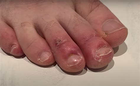 Chilblains What You Need To Know Symptoms Pictures
