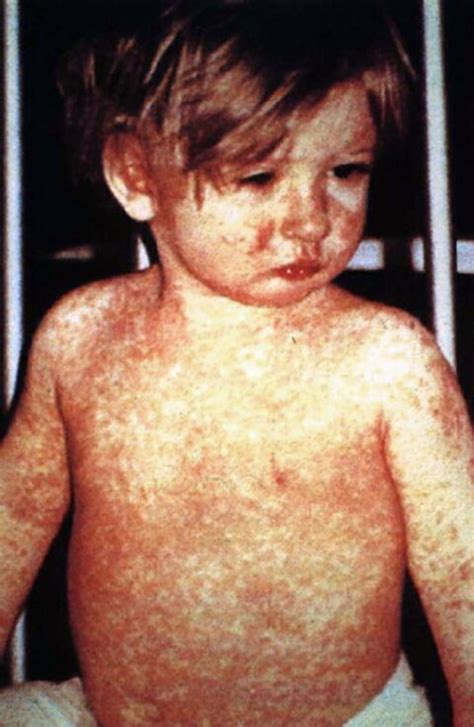 Measles Symptoms Prevention And Treatment Biology Ease