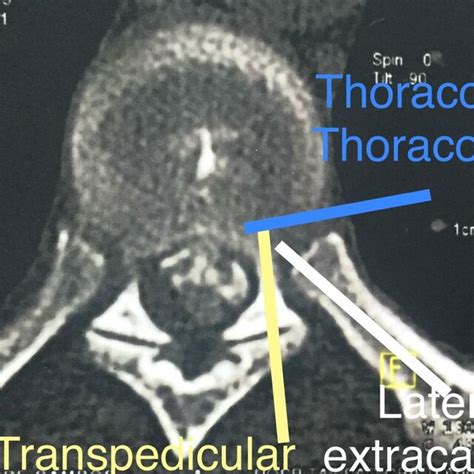 Different Approaches Described To Treat Thoracic Disc Herniation