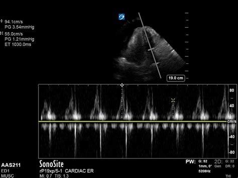Sonoguide Rapid Ultrasound For Shock And Hypotension Rush