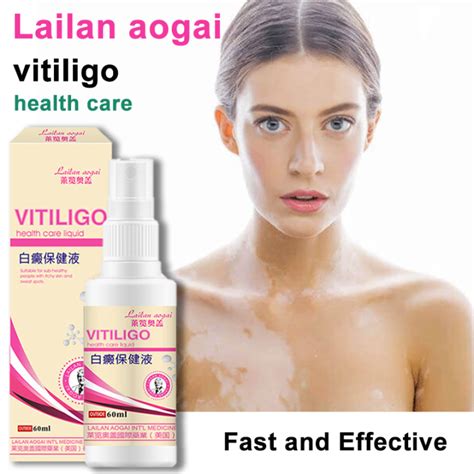 【vitiligo Nemesis】vitiligo Treatment Cream Vitiligo Remover Vitiligo