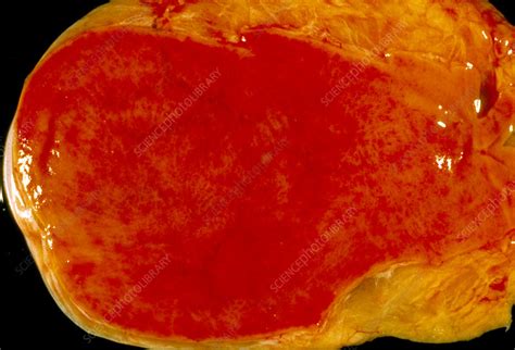 Gallbladder Inflammation Stock Image M1300628 Science Photo Library