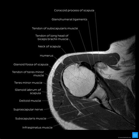 shoulder mri normal anatomy e anatomy porn sex picture