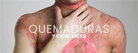 Tratamiento De Quemaduras Y Cicatrices