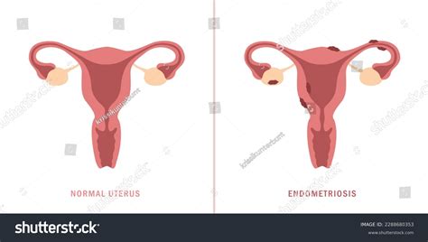 Endometriosis Normal Uterus Womens Health Anatomy Stock Illustration