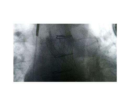 Cxr Findings In Cardiology Pptx Heart And Cardiovascular Diseases Diseases And Conditions