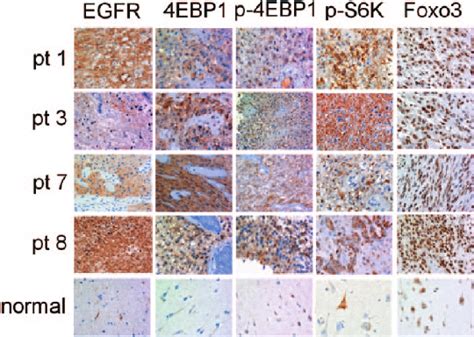 Immunohistochemistry Of Four Glioblastomas Detects Elevated Levels Of Download Scientific