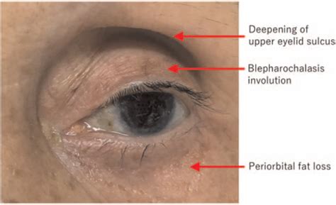 Proposal Of A Simple Grading System Integrating Cosmetic And Tonometric Aspects Of Prostaglandin