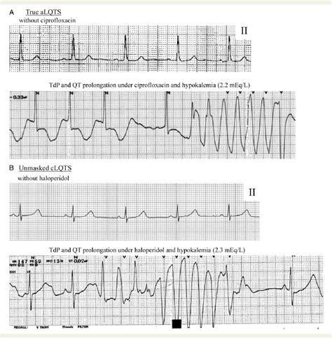 Long Qt Syndrome Congenital Semantic Scholar