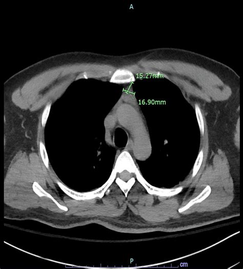 Thymic Mass Computed Tomography Of The Chest Showing Anterior