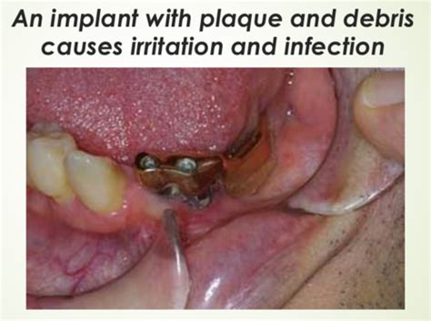 Implant Maintenance Flashcards Quizlet