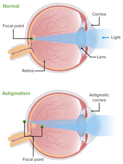 Refractive Errors Concise Medical Knowledge