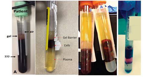 Errors In Specimen Collection And Processing Part 1