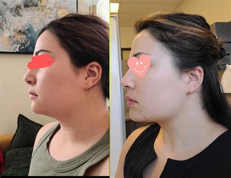 Mewing Before And After With Dr Mew Mewing App