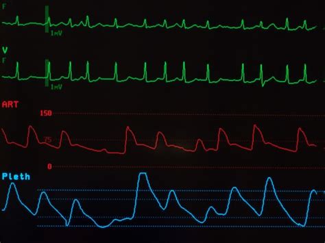What Causes AFib And How Can You Avoid It The Emergency Center