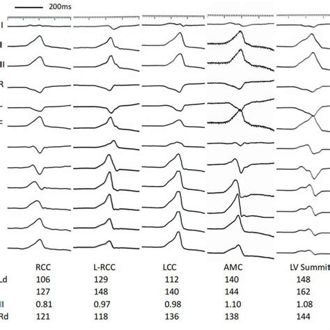Examples Of The Electrocardiographic Morphology Of Ventricular Download Scientific Diagram