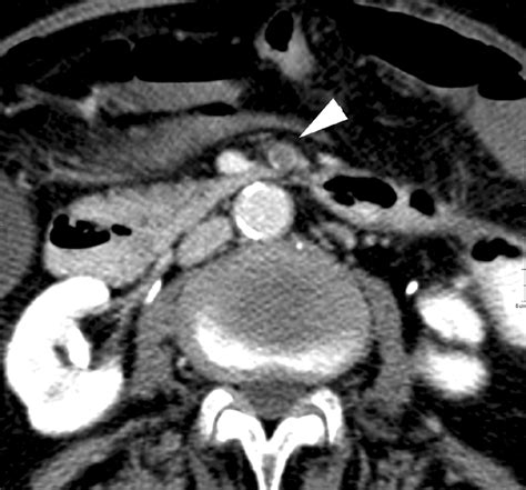 Cta And Mra In Mesenteric Ischemia Part 1 Role In Diagnosis And Differential Diagnosis Ajr