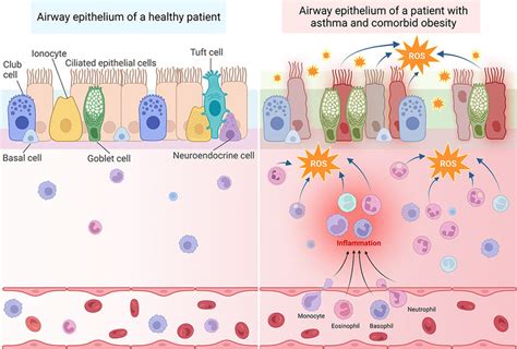 Oxidative Stress In Patients With Asthma And Comorbid Obesity