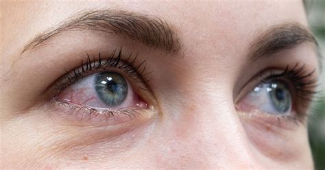 Gonorrhea Eye Conjunctivitis Description Causes Symptoms