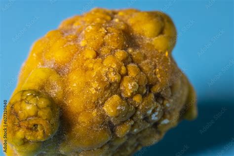 Gallstones Multiple Cholesterol Stone In Gallbladder With Cholecystitis Gallbladder Disease
