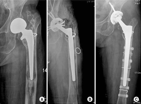 A Preoperative Radiograph Showed Loosening Of Cemented Stem And