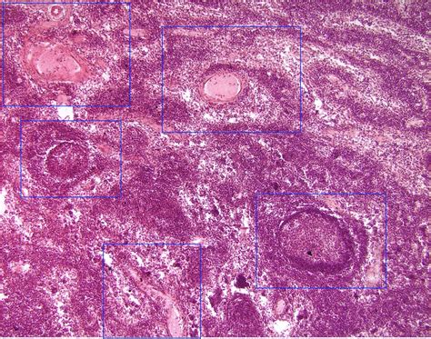 Medula Of Lymph Node At 100x Magnification