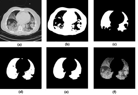A D CNN Network With BERT For Automatic COVID Diagnosis From CT Scan Images DeepAI