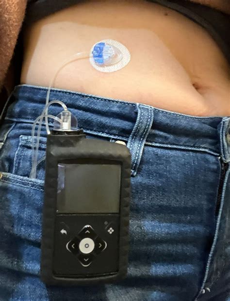 A Month On Medtronic Minimed 780g Insulin Pump Comparison
