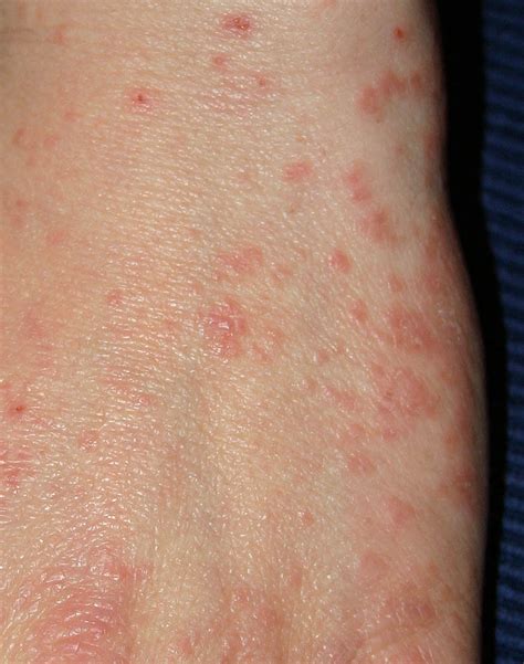 Lice And Scabies Diary Of A Caribbean Med Babe