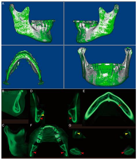 The Dolphin 3d Voxel Based Superimposition Of The Initial White Cbct