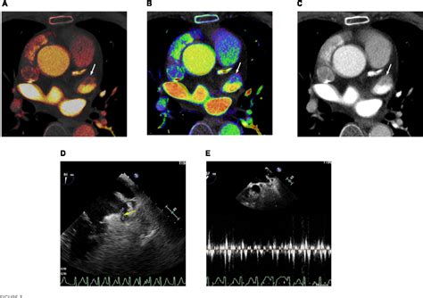 Figure 1 From Detection Of Left Atrial Appendage Thrombus By Dual Energy Computed Tomography