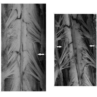 A Unilateral Intradural Intersegmental Connection Between C5 And C6 Download Scientific