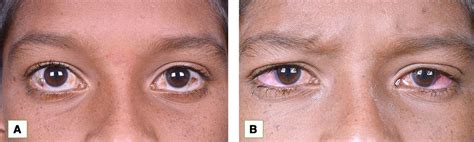 Mild Xeroderma Pigmentosum