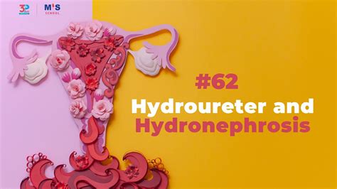 Hydroureter And Hydronephrosis Youtube
